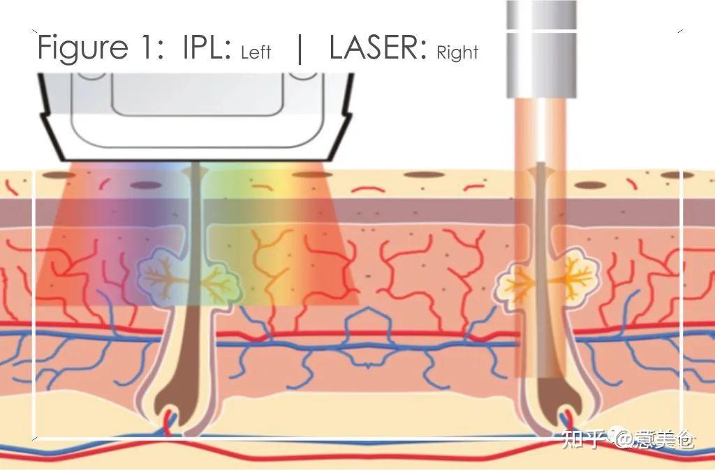 光子嫩肤IPL、OPT、AOPT、DPL、APT、BBL大盘点 - 知乎