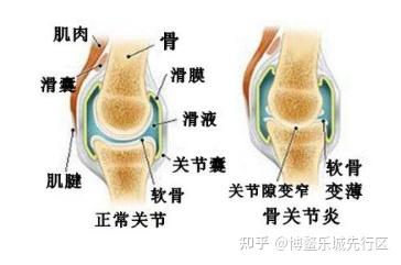 告别膝骨关节炎疼痛！一文了解乐城全球创新nSTRIDE®自体蛋白注射疗法 - 知乎
