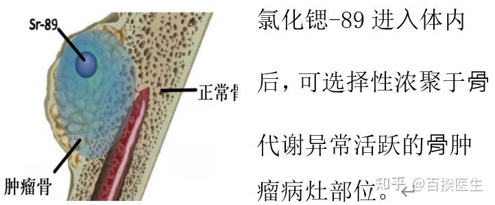 一文讲清楚：氯化锶（89Sr）注射液，让骨转移患者不再疼痛 - 知乎