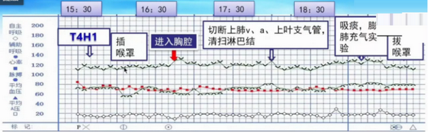 麻醉视角丨王强教授：T4H1-VATS技术应用于胸科手术的探索 - 知乎