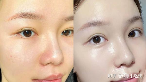 为啥我强烈建议想要快速美白时，一定要用涂抹式美白针？！ 知乎