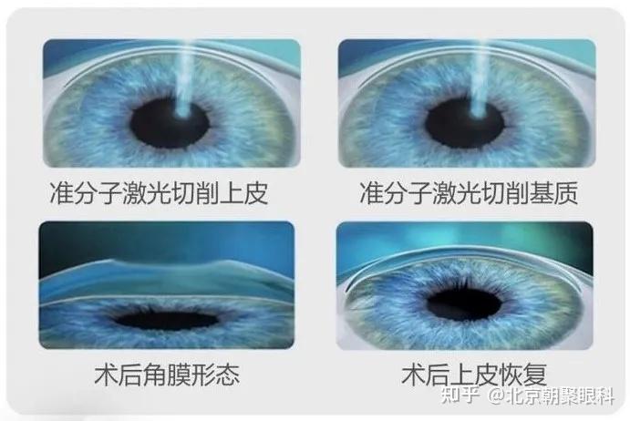揭秘全激光（Trans-PRK）：何以成为表层手术的主流？ - 知乎