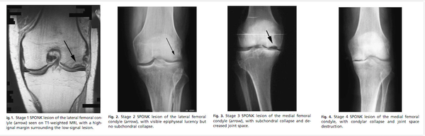SONK（Spontaneous osteonecrosis of the knee）的诊断及治疗概述 - 知乎