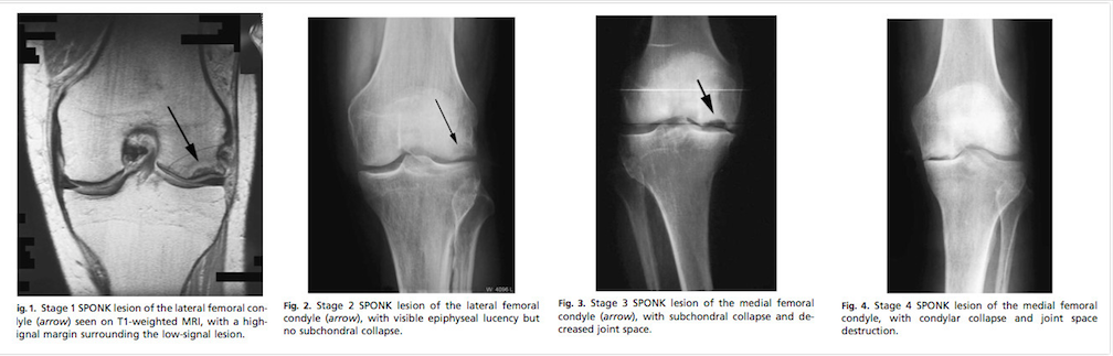 SONK（Spontaneous osteonecrosis of the knee）的诊断及治疗概述 - 知乎