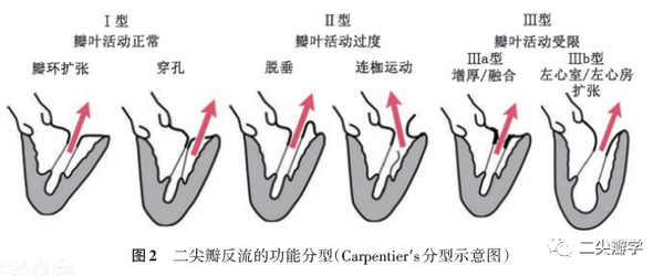 【指南与共识】经导管二尖瓣缘对缘修复术的中国专家共识 - 知乎