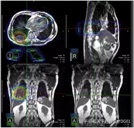ViewRay MRIdian 磁共振引导放疗 - 知乎