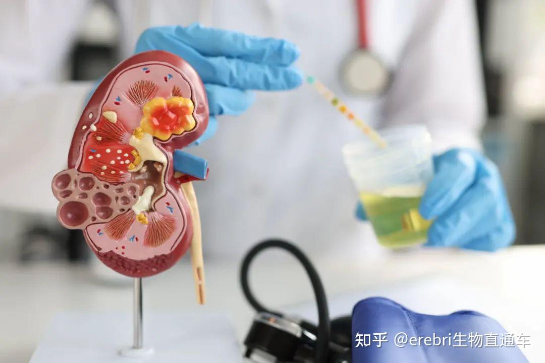 晚期肾癌治疗新靶点！最新研究成功构建晚期肾癌预测模型，让预后治疗更准确 - 知乎