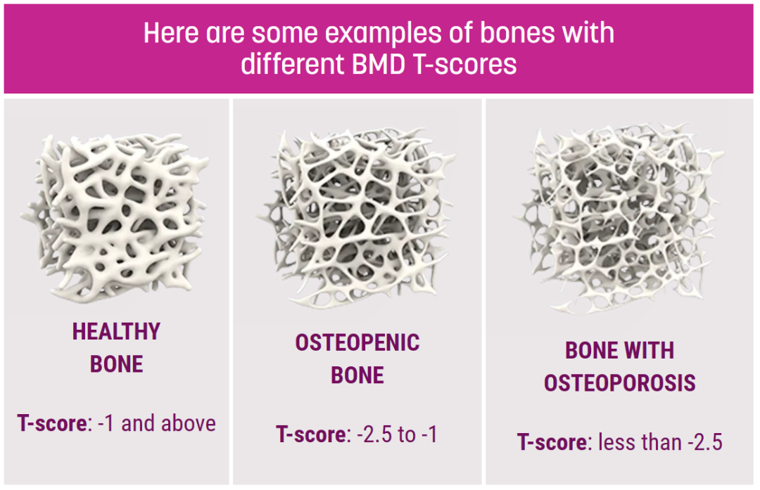 快讯 | Radius宣布TYMLOS®获批治疗男性骨质疏松症 - 知乎