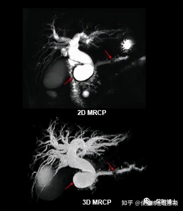什么是MRCP，为什么要做这个检查？ - 知乎