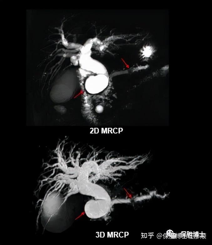 什么是MRCP，为什么要做这个检查？ - 知乎