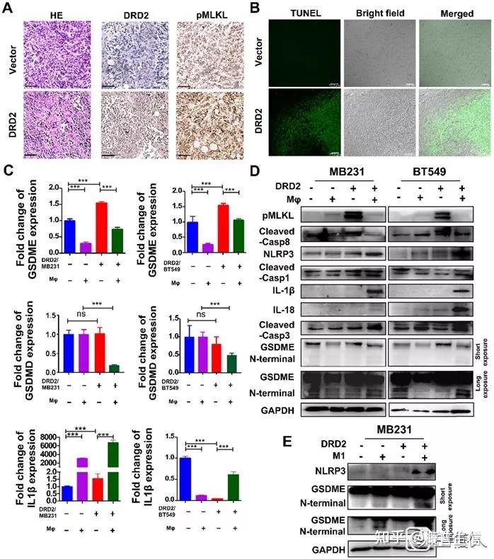 生信数据挖掘 DRD2能触发乳腺癌细胞焦亡 - 知乎