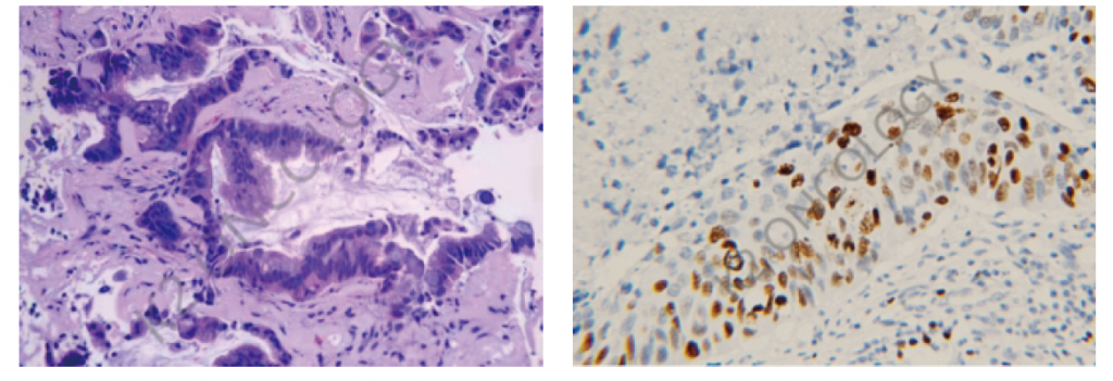 PDOX模型药物评价 - 知乎