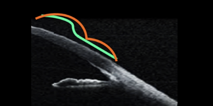 CRT设计和VST设计角膜塑形镜的区别 - 知乎