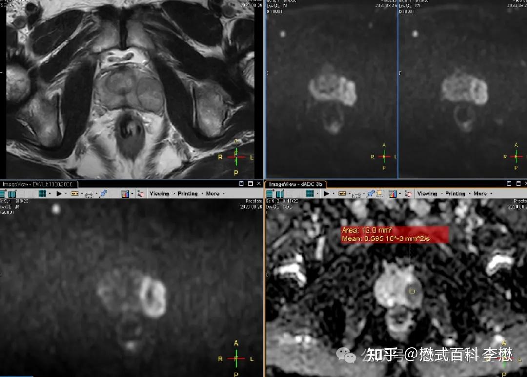 前列腺磁共振中mp-MRI、bp-MRI和abp-MRI - 知乎