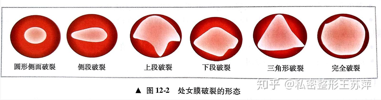 初次性生活不出血是否意味着女性不 纯洁”？ 知乎