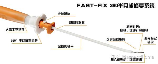 半月板缝合全内(All-inside)技术解读 - 知乎