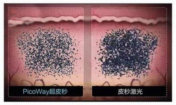 超皮秒Picoway比皮秒Picosure效果更好？ - 知乎