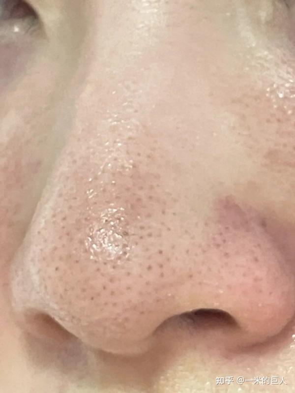 如果你脸上天天冒油,鼻子上黑头扎堆,又大又硬,用了很多方法都没办法,可以看看我的经历(非盈利回答) 知乎