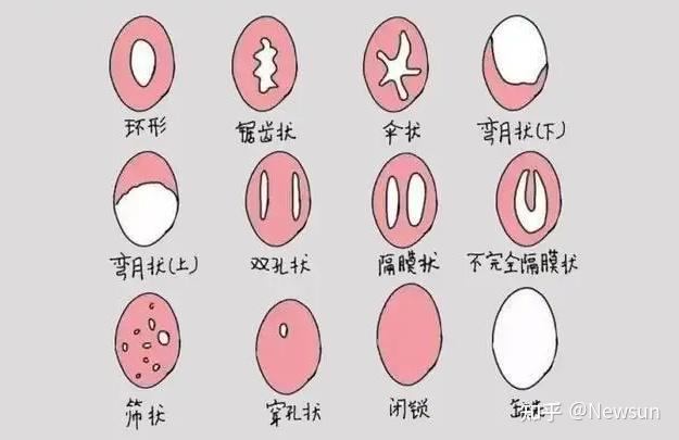 处女膜,压根不是膜!为什么还有人在修复处女膜? 知乎