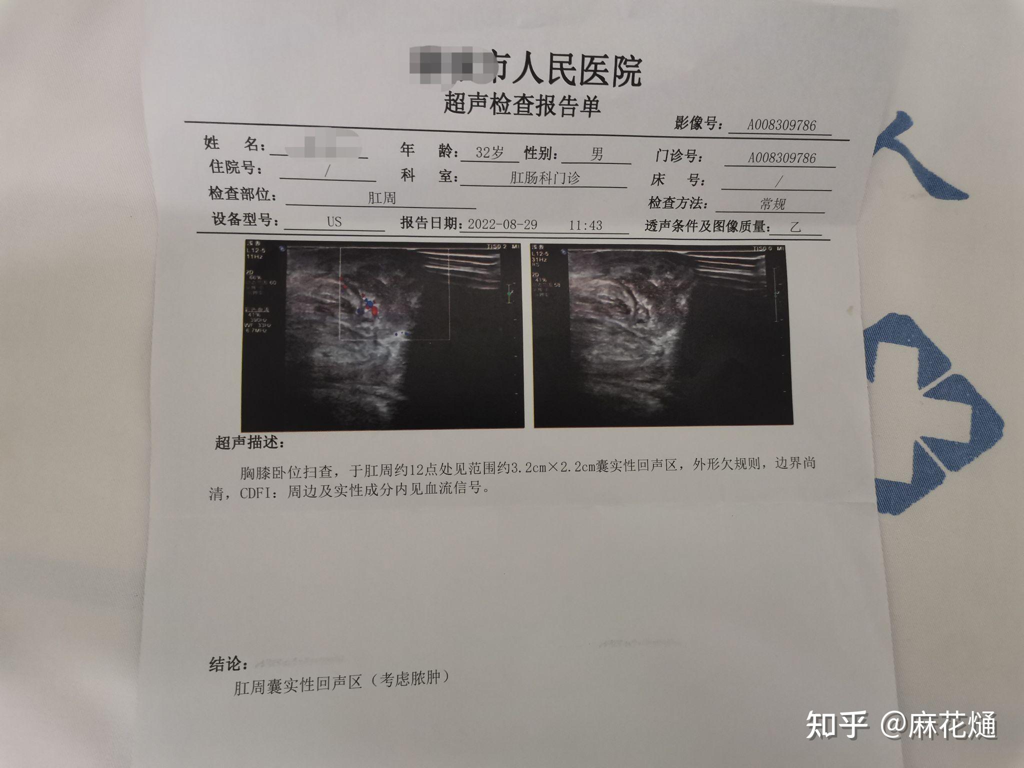 我的肛门里长了个硬块 知乎
