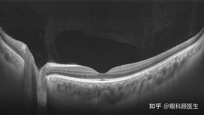 什么是OCT检查？ - 知乎