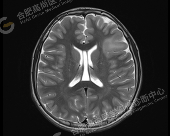 病例科普：头颅MR诊断局灶性皮层发育不良（FCD） - 知乎