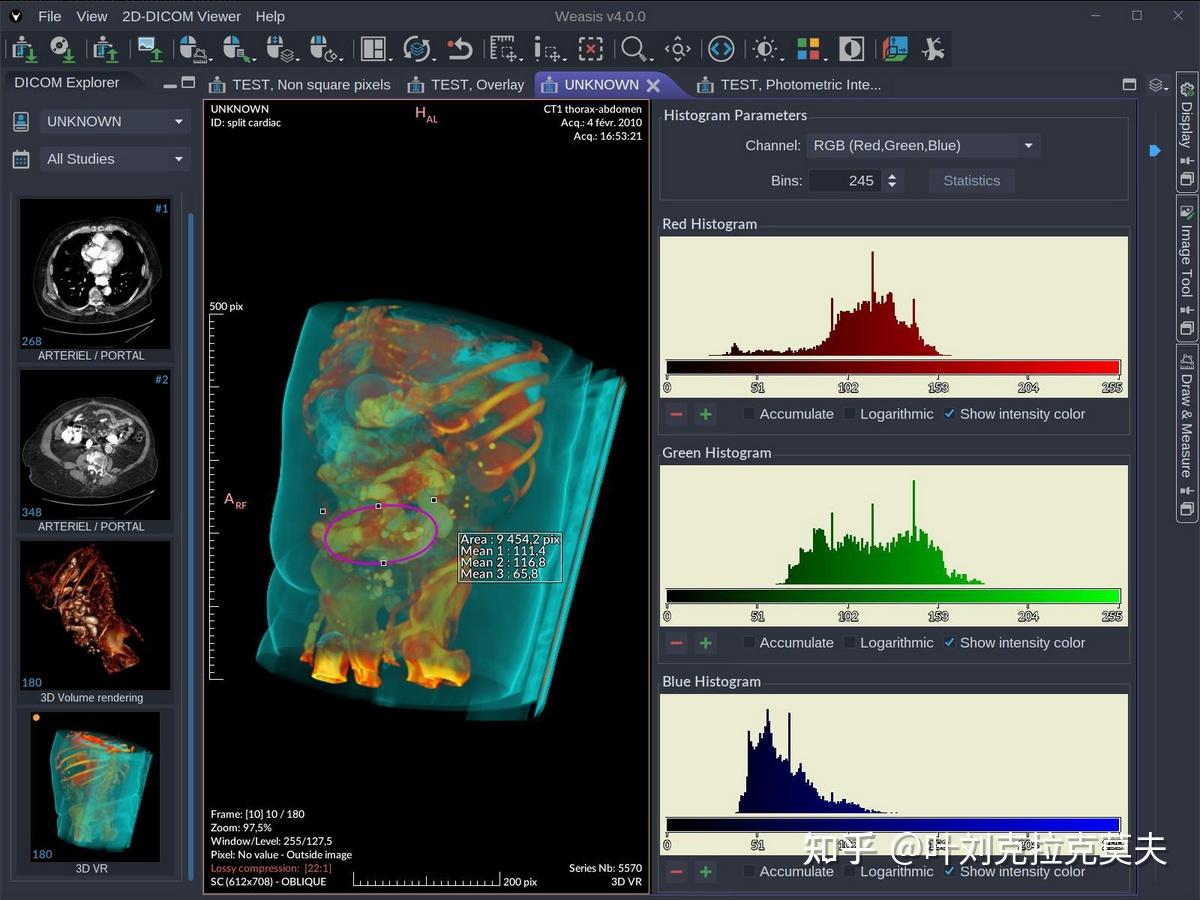开源科学工程技术软件介绍16 – DICOM医学图片查看器Weasis - 知乎