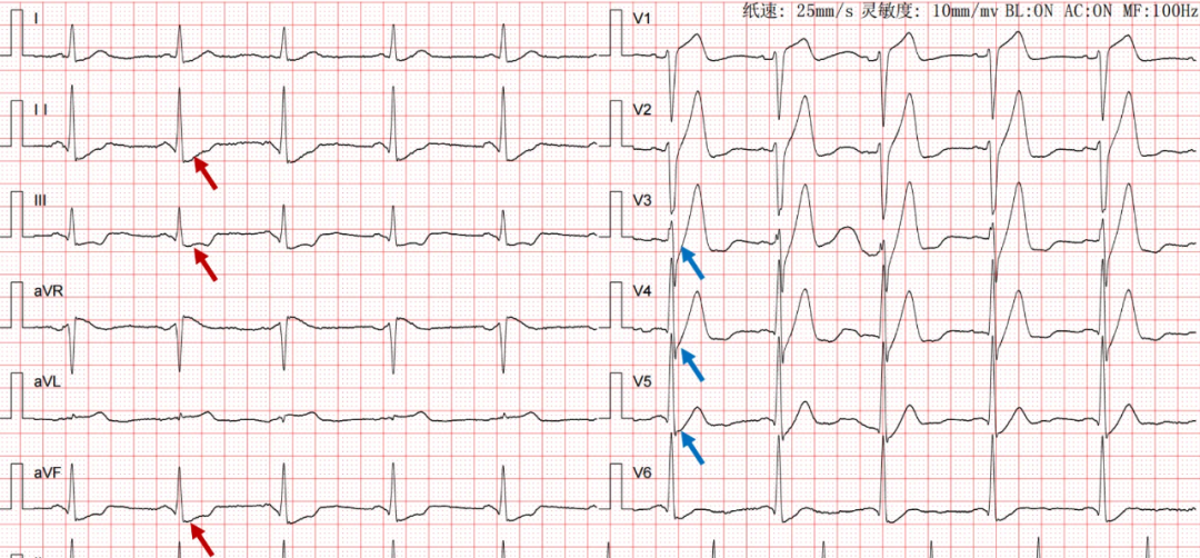 STEMI 等危心电图：“6+2”现象、Wellens征、de Winter 征 - 知乎