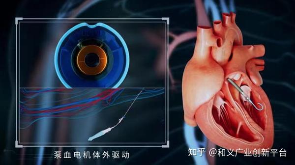 人工心脏5——一文浅析短期PVAD（下） - 知乎