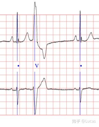 智能医疗（1）—— ECG心电图基础 - 知乎