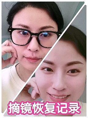 Tprk smart 准分子激光 全激光 术后恢复分享 - 知乎