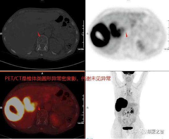 PET/CT与MRI联合诊疗——全面评估与精准诊断的完美结合 - 知乎