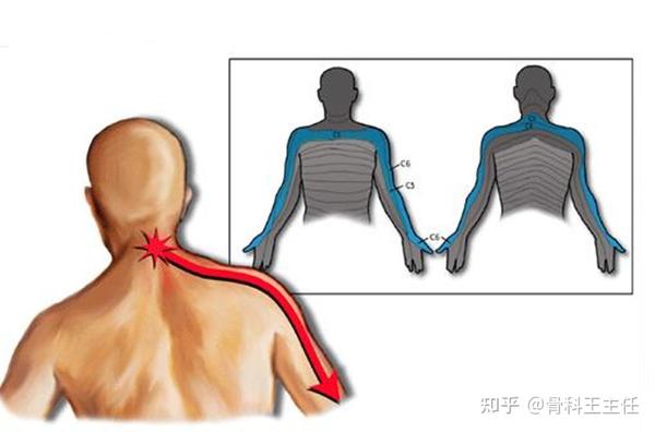 肩膀痛一直治不好，问题可能出在脖子 知乎