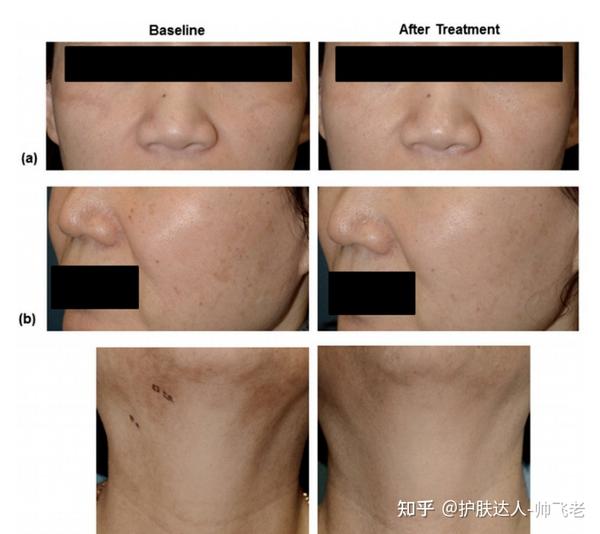 PDRN是什么？ - 知乎