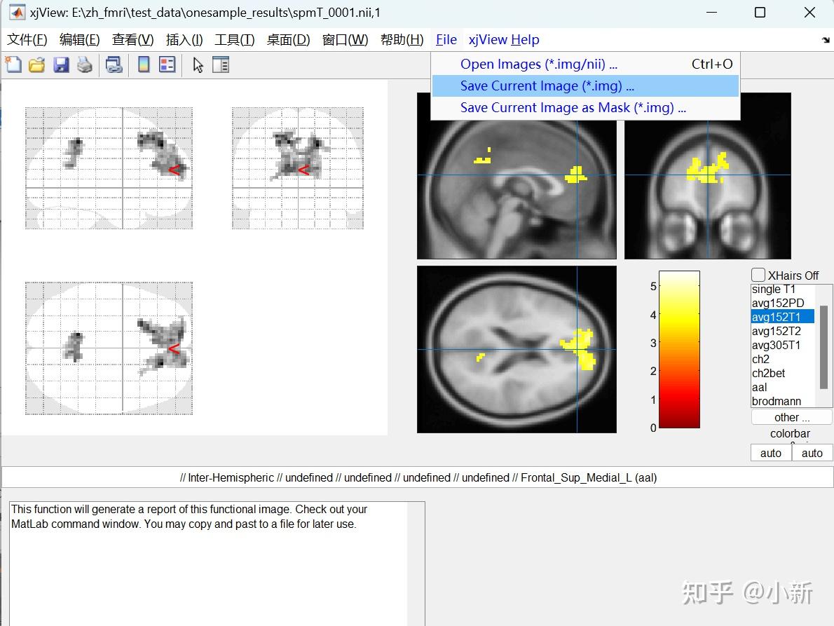 15（1）-SPM-fmri任务态 结果查看与汇报 xjview - 知乎