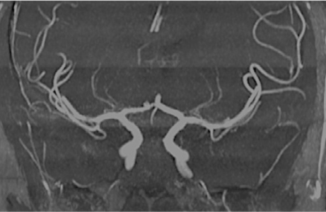 TOF MRA 伪影总结 - 知乎