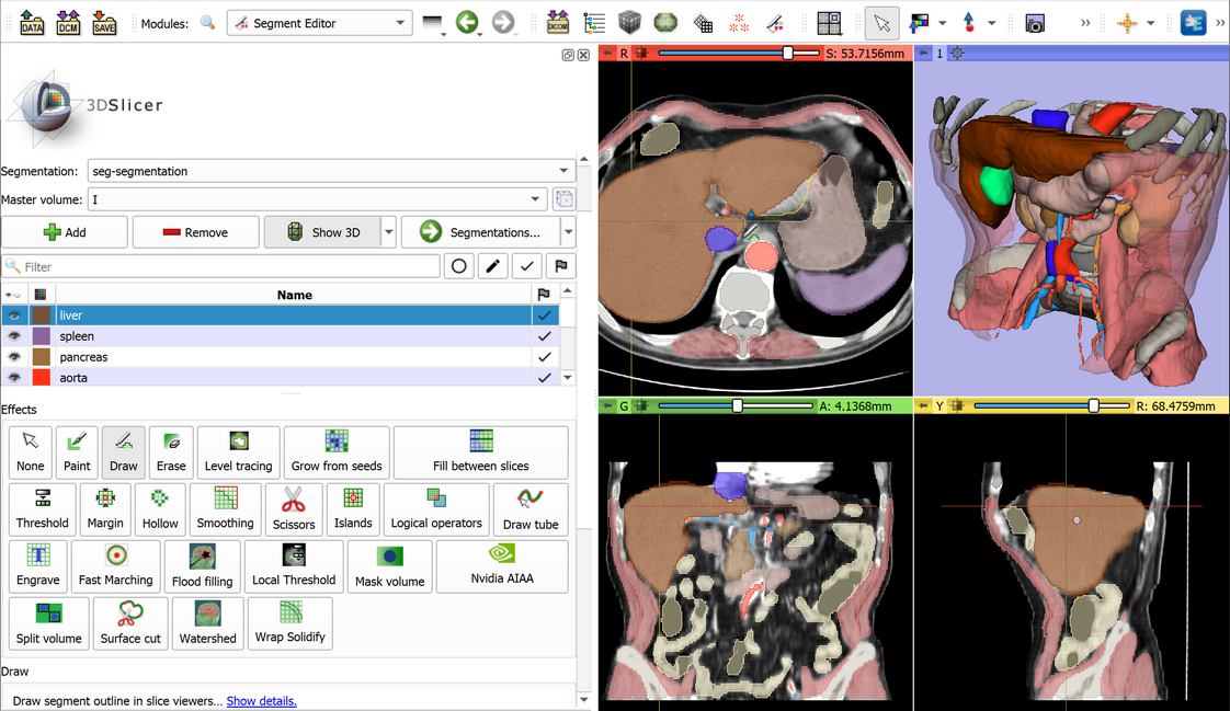 DICOM 图像浏览器和影像科研平台推荐（附 Radiant Viewer、3D Slicer 安装包） - 知乎