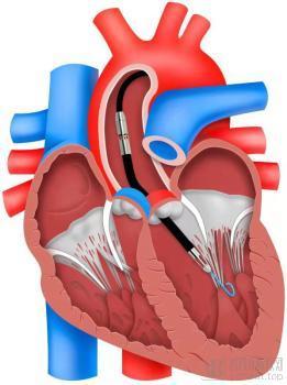 医学和航空航天跨专业碰撞，胡盛寿院士团队打破pVAD技术海外垄断 - 知乎