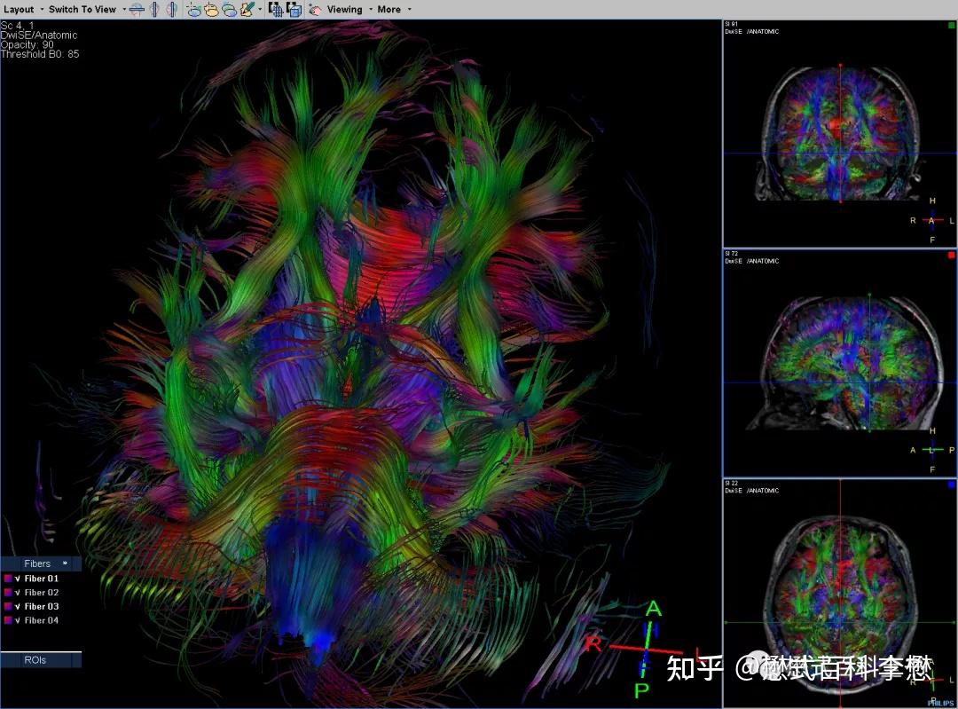 DTI技术原理及临床应用 - 知乎