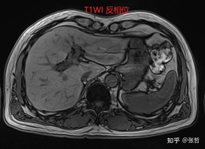 一篇文章解释清楚T1WI和T2WI - 知乎