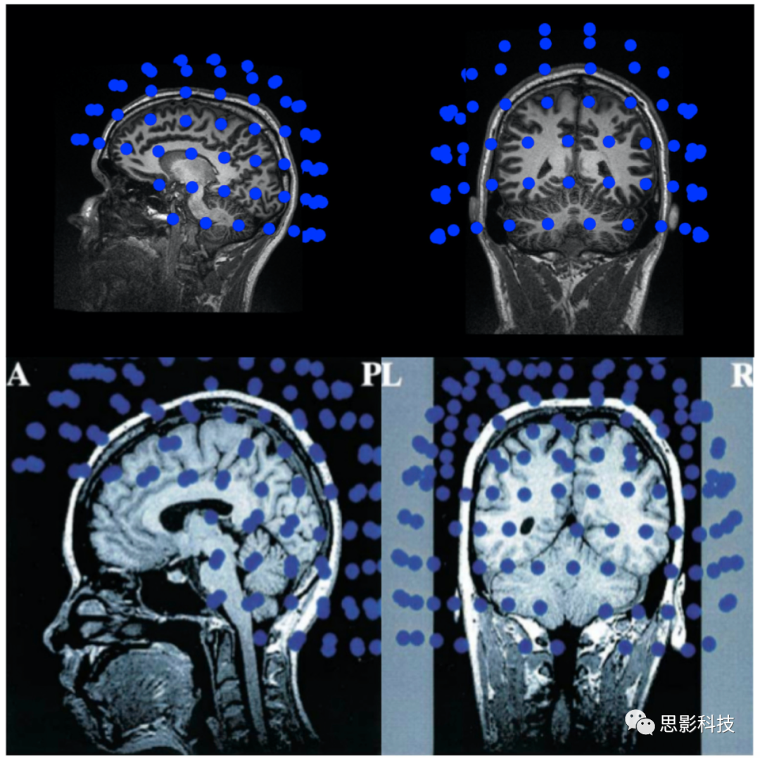 EEG和MEG是否可以检测到小脑信号？ - 知乎