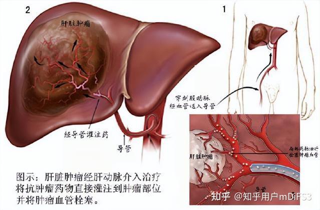 HAIC是啥？HAIC治疗适合所有肝癌患者吗？ - 知乎