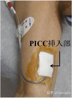 PICC（末梢留置型中央静脉导管）的管理技巧 - 知乎