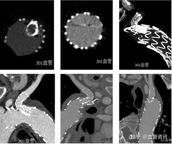 WeFlow-Tbranch单内嵌分支胸主动脉覆膜支架系统临床试验随访结果 - 知乎