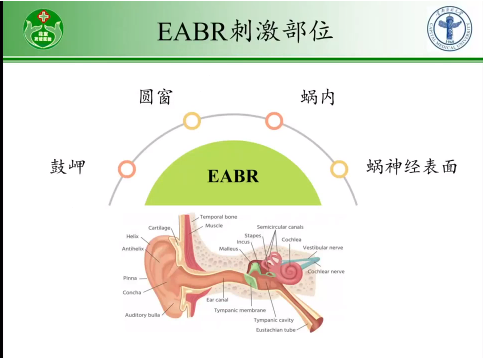 临床听力学技术专业沙龙｜人工耳蜗植入术中及术后EABR的应用 - 知乎