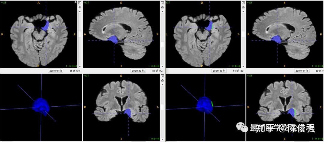 BraTS2023-MEN——BraTS2023颅内脑膜瘤分割挑战赛 - 知乎