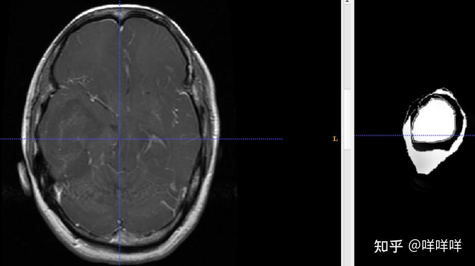 FSL用于脑部MRI图像配准: （flirt与ants刚性与弹性配准） - 知乎