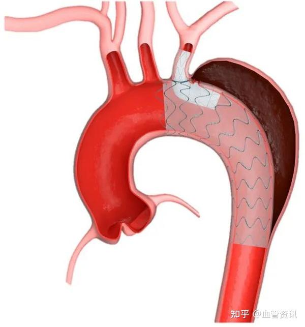 WeFlow-Tbranch单内嵌分支胸主动脉覆膜支架系统临床试验随访结果 - 知乎