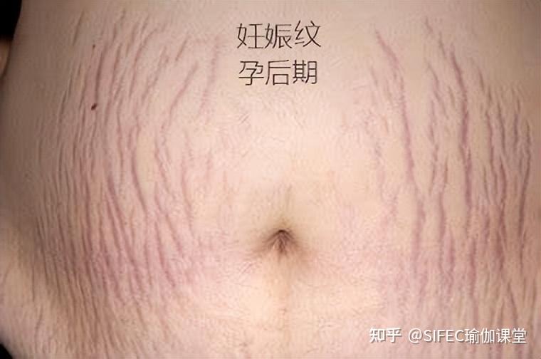 妊辰纹?妊娠纹!产中预防,产后修复,稳了 知乎