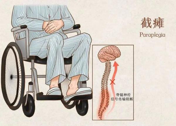 脊髓损伤（截瘫）还能治好吗？该怎么治？ - 知乎